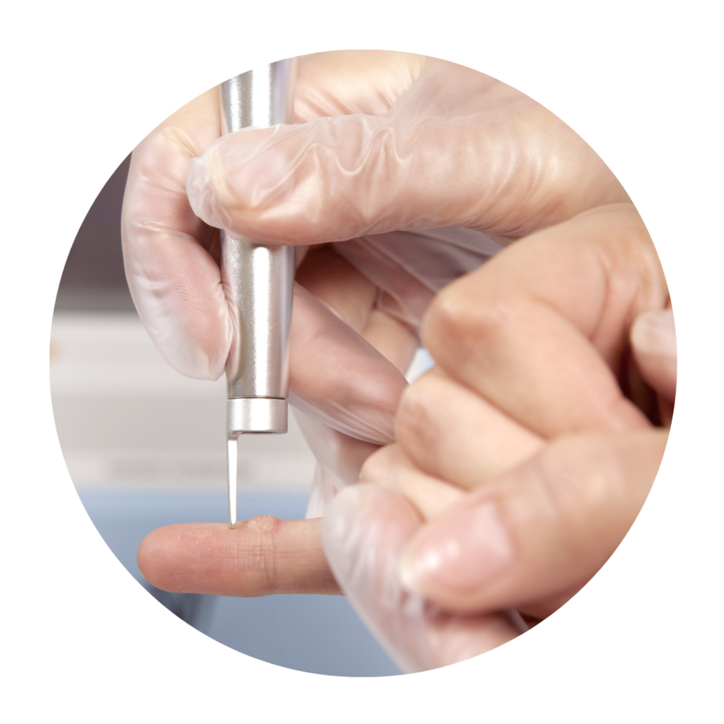 Warts - Richmond Square Medical