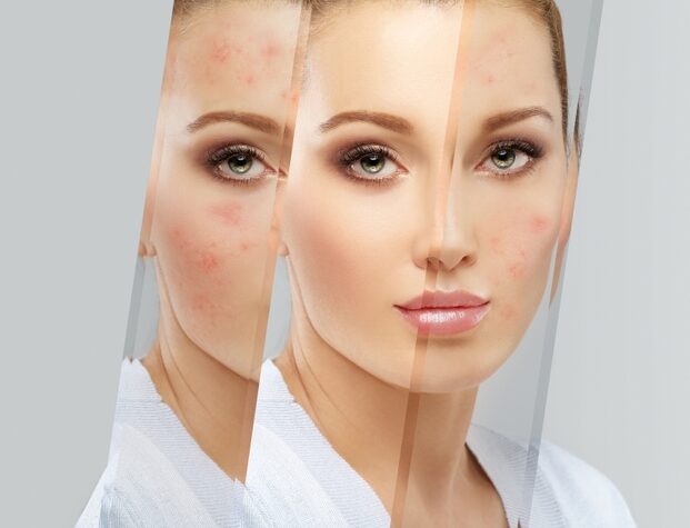 Rosacea (row-zay-sha) - Richmond Square Medical