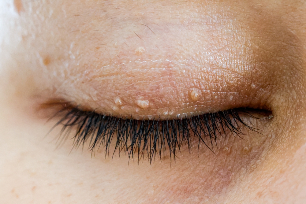 Skin Tags & Other Lesions - Richmond Square Medical