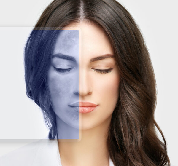 Hyperpigmentation - Richmond Square Medical