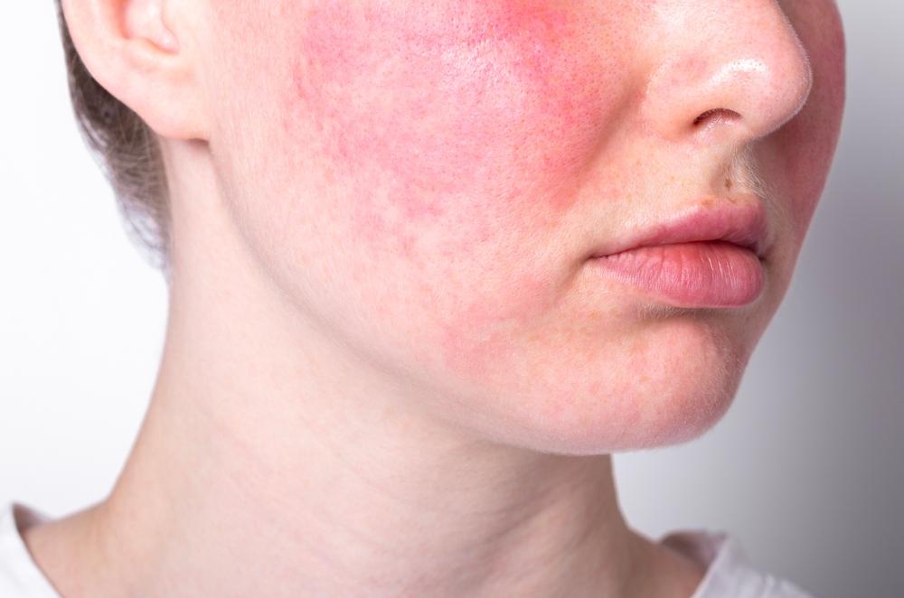 Diffuse Redness - Richmond Square Medical